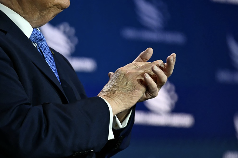 Trump's hand looks 'algae' green as he criticizes the 'election of ...