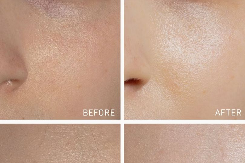 LED mask that makes skin look brighter and reduces rosacea in just a ...